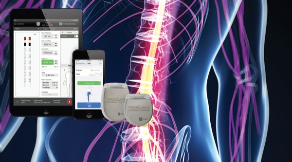 Abbott spinal cord stimulator burst settings - railpolf