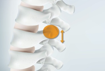 Interspinous Spacer Shown Effective for Severe Pain of Lumbar Spinal ...