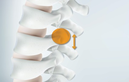Interspinous Spacer Shown Effective for Severe Pain of Lumbar Spinal ...