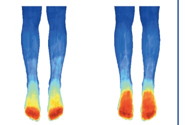 High-Frequency SCS Shows Potential in Long-Term Painful Diabetic Neuropathy