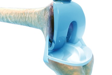 Periarticular Morphine Injection To Adductor Canal Block and IPACK in ...