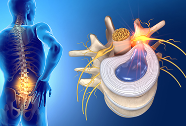 Intrathecal Pain Management in Lumbar Radiculopathy