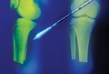 Understanding Phantom Limb Pain