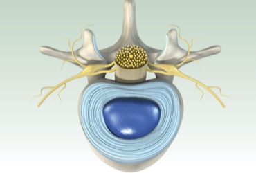 Cellular Transformation Implicated in Discogenic Back Pain
