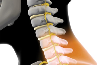 Cervical Facet Joint Radiofrequency Neurotomy Improves Pain, Function ...